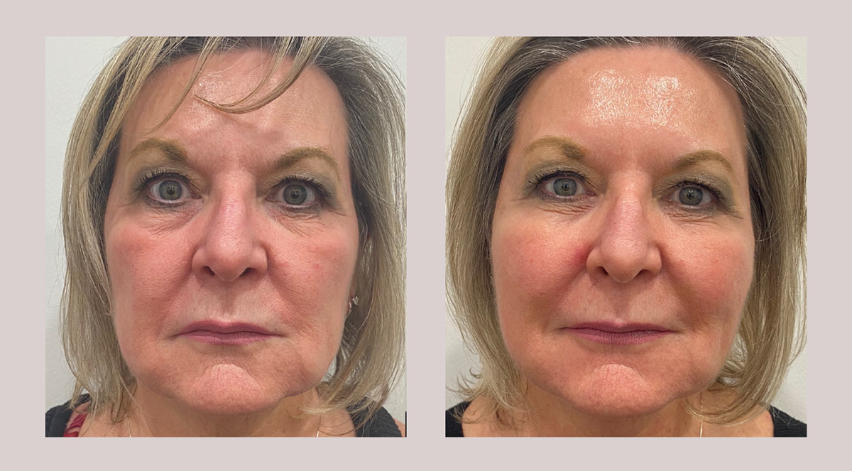 Before & After Photo: Thread Lift + Filler | MD Beauty Clinic