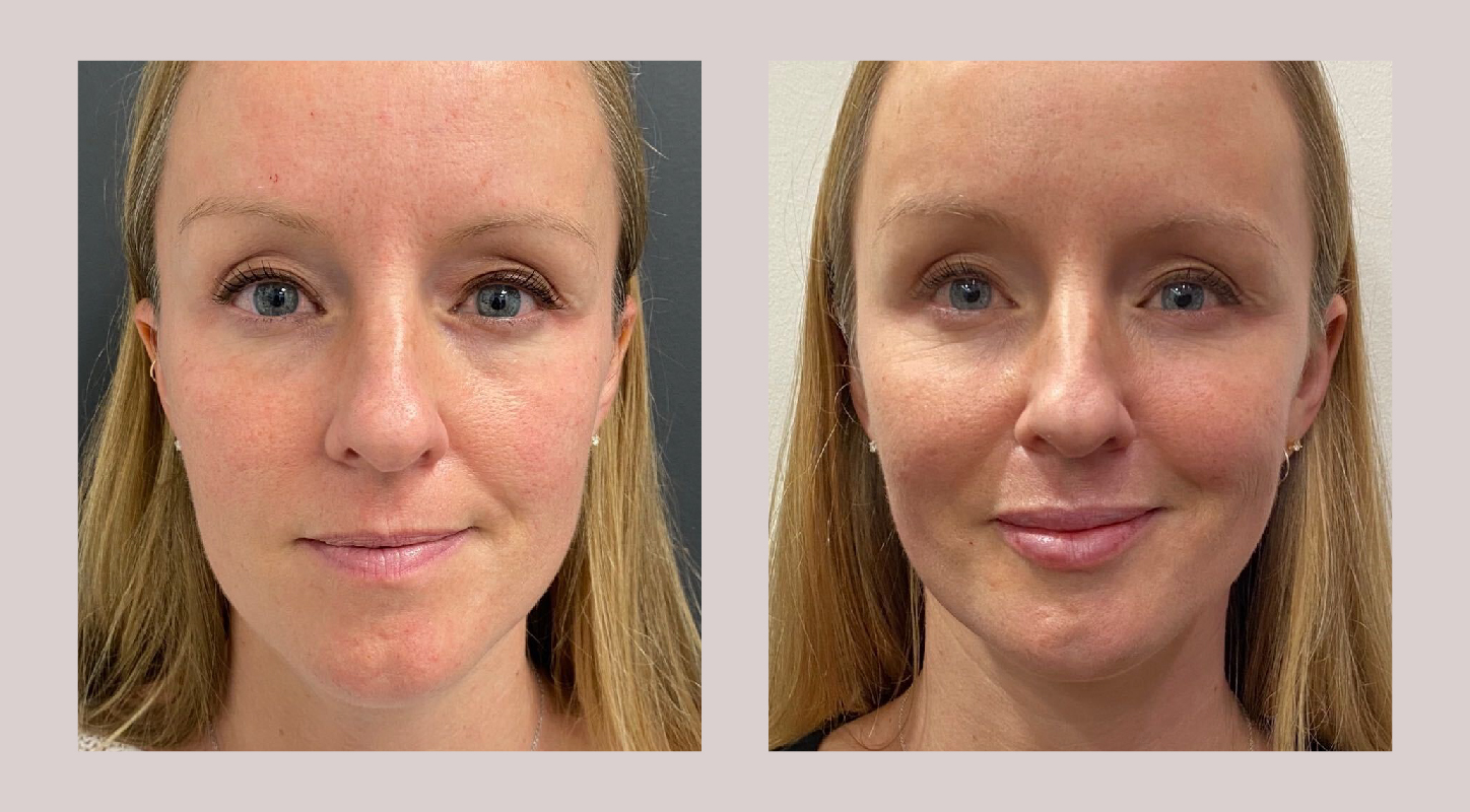 Before & After Photo: Facial Filler | MD Beauty Clinic Blog